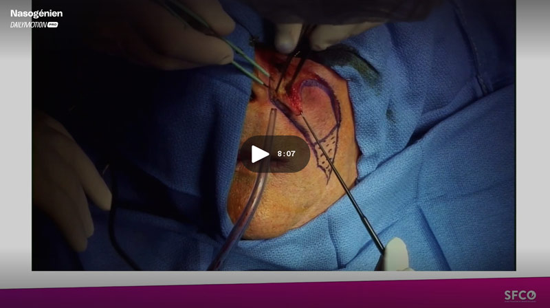 Le lambeau nasogénien en ilôt pour la réparation des PDS de la cavité bucale - Société ...